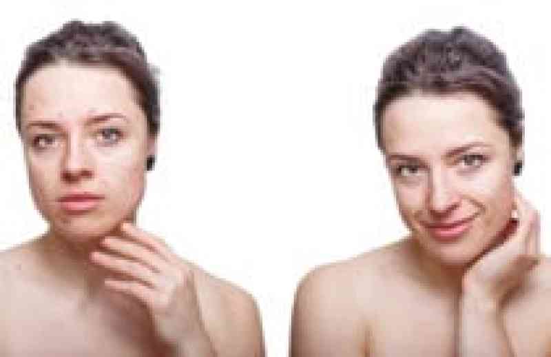 Underarm Botox: A Life-Changing Solution for Hyperhidrosis