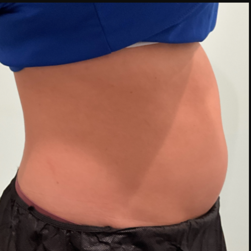 Real People, Real Results: EMSCULPT NEO Before and After Transformations